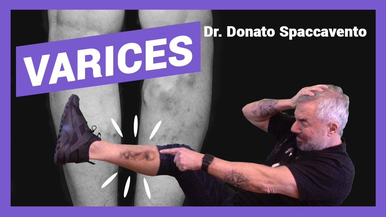 VARICES en las piernas | Causas, síntomas y tratamiento - YouTube