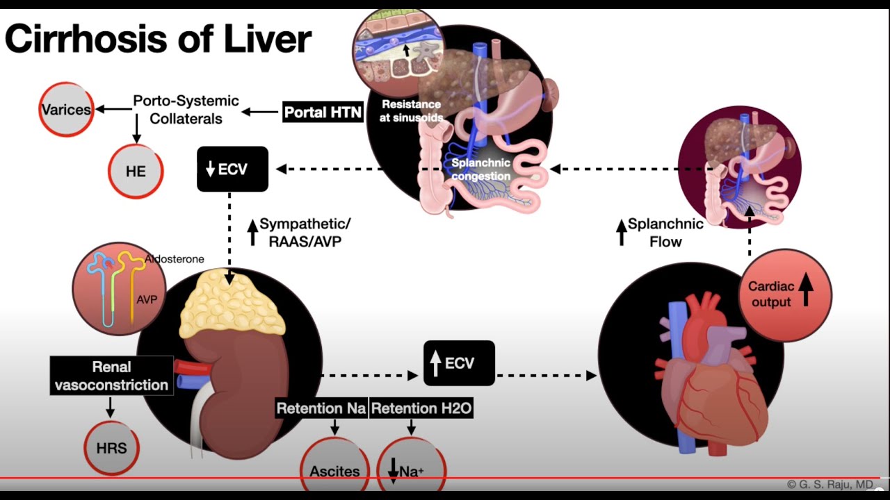 Liver-Cirrhosis-Ascites-1c-Pathophysiology - YouTube