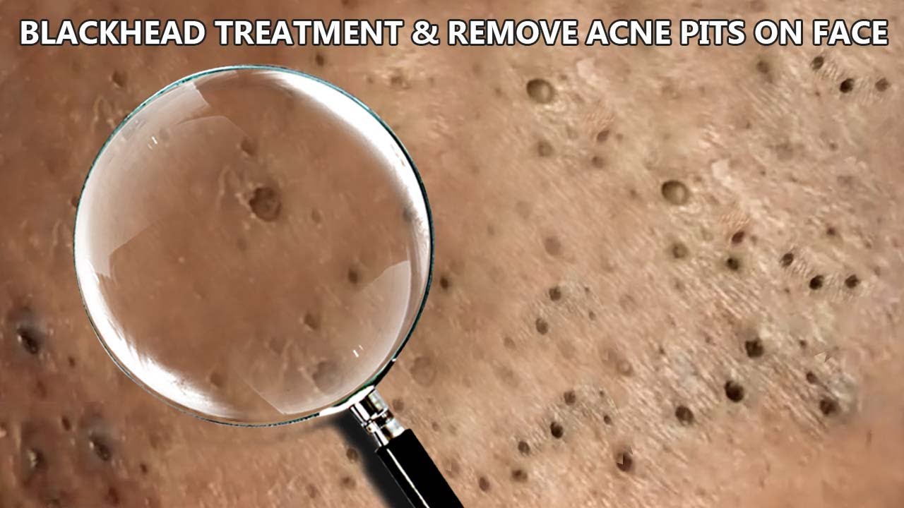 Pimple Popping Scenes Satisfy Viewers | Blackhead Removal | Acne ...