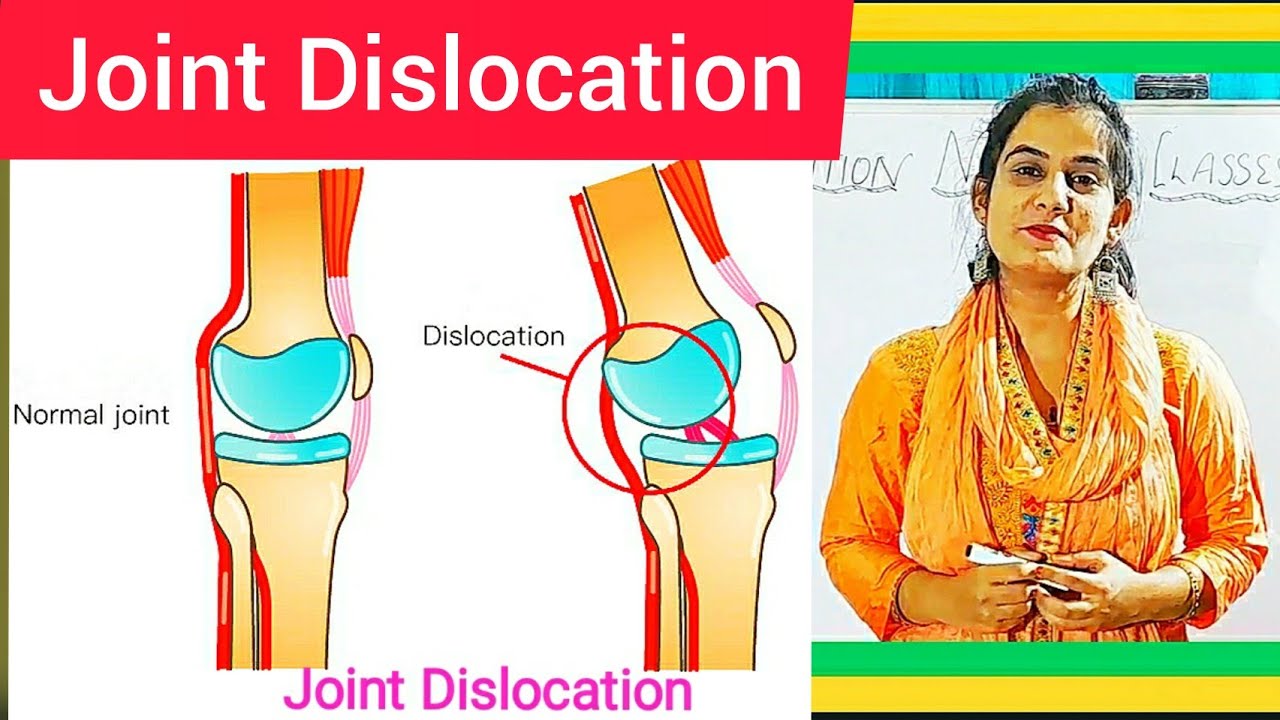 Joint Dislocation : Causes, Symptom, Treatment, Diagnosis, Medical ...