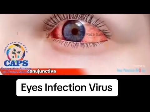 Pakistan ma eyes infection virus k bharte Howe case SE #pakistan # ...