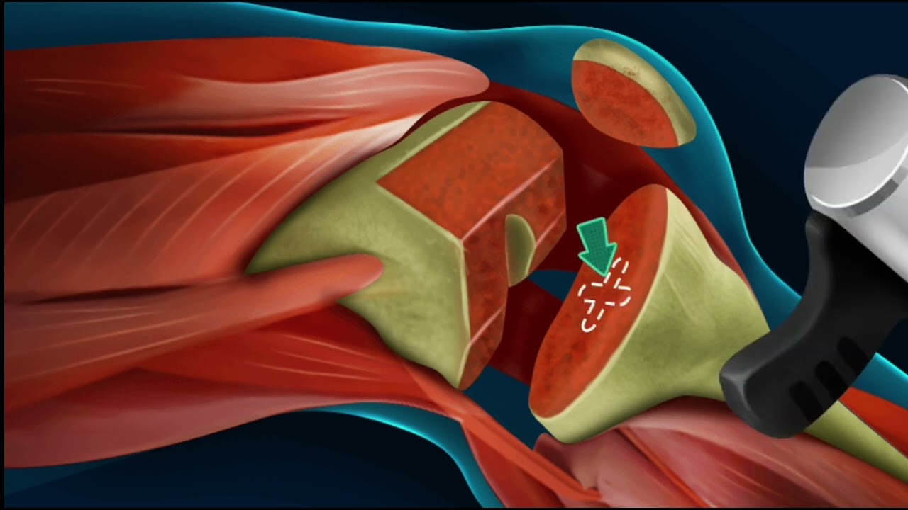 Leg Knee Surgery Animated Video| Foot care Animation - YouTube