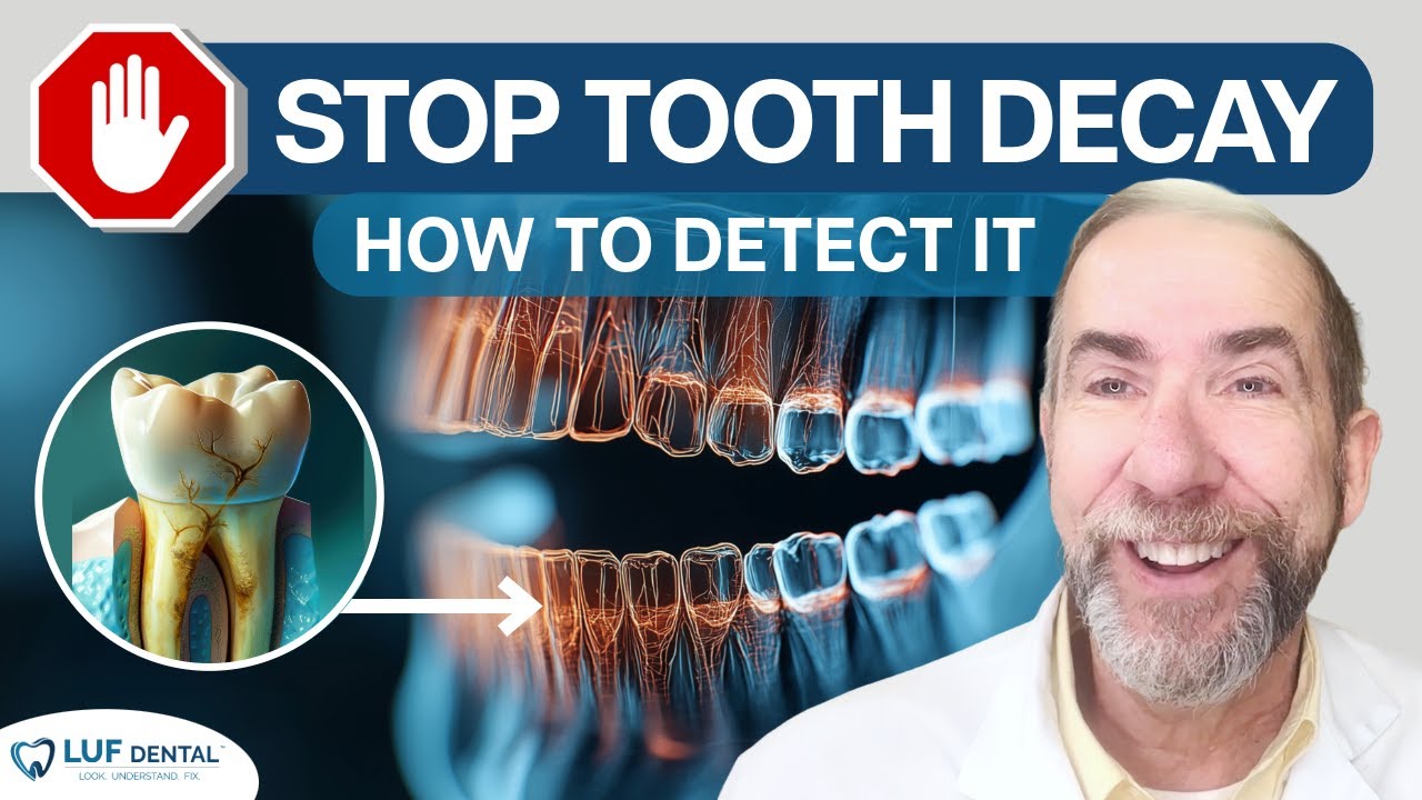 STOP Tooth Decay - Signs & Treatment - YouTube