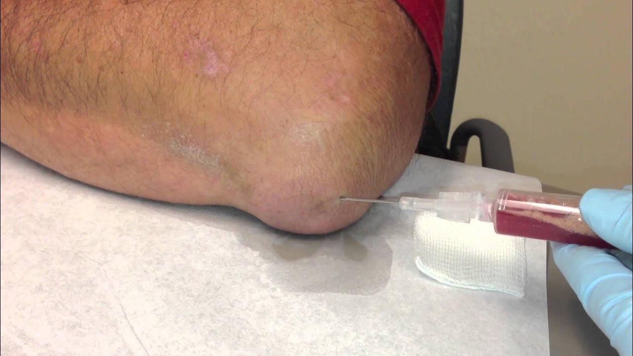 SdMskProject Olecranon Bursa Aspiration - YouTube