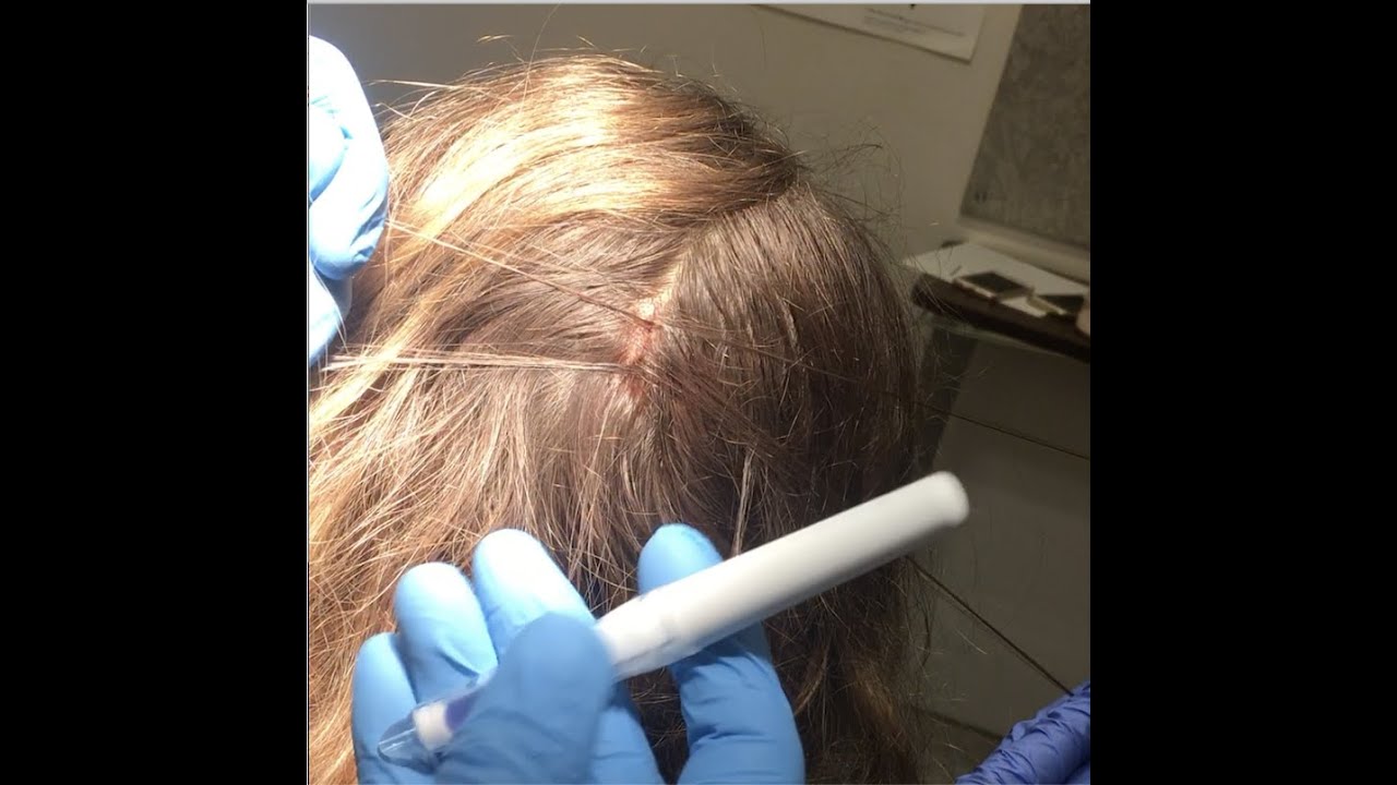 Synchronous HAT- A synchronous method of the Manual Hair Apposition ...