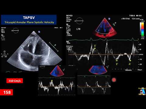 Step By Step RV Evaluation Part 2: TAPSE, TAPSV & RIMP - YouTube