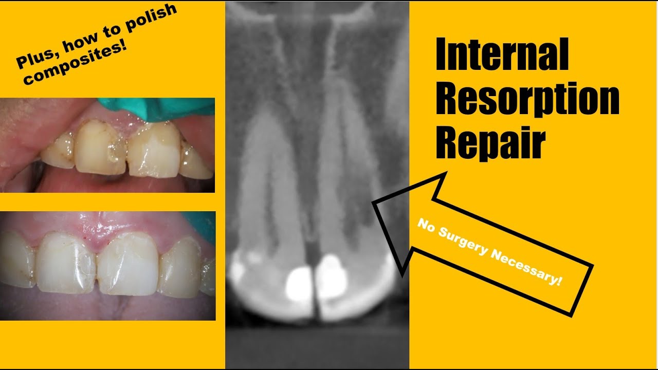 Internal Resorption Repair Without Surgery (With a BONUS!) - YouTube