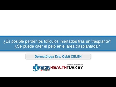 ¿Es posible perder los folículos tras un trasplante? ¿Se puede caer el pelo en el área trasplantada?