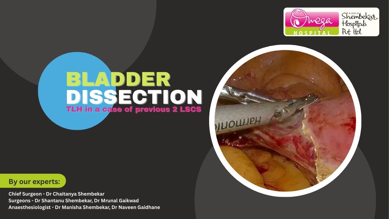 TLH in a case of previous 2 LSCS- Bladder dissection made easy. - YouTube