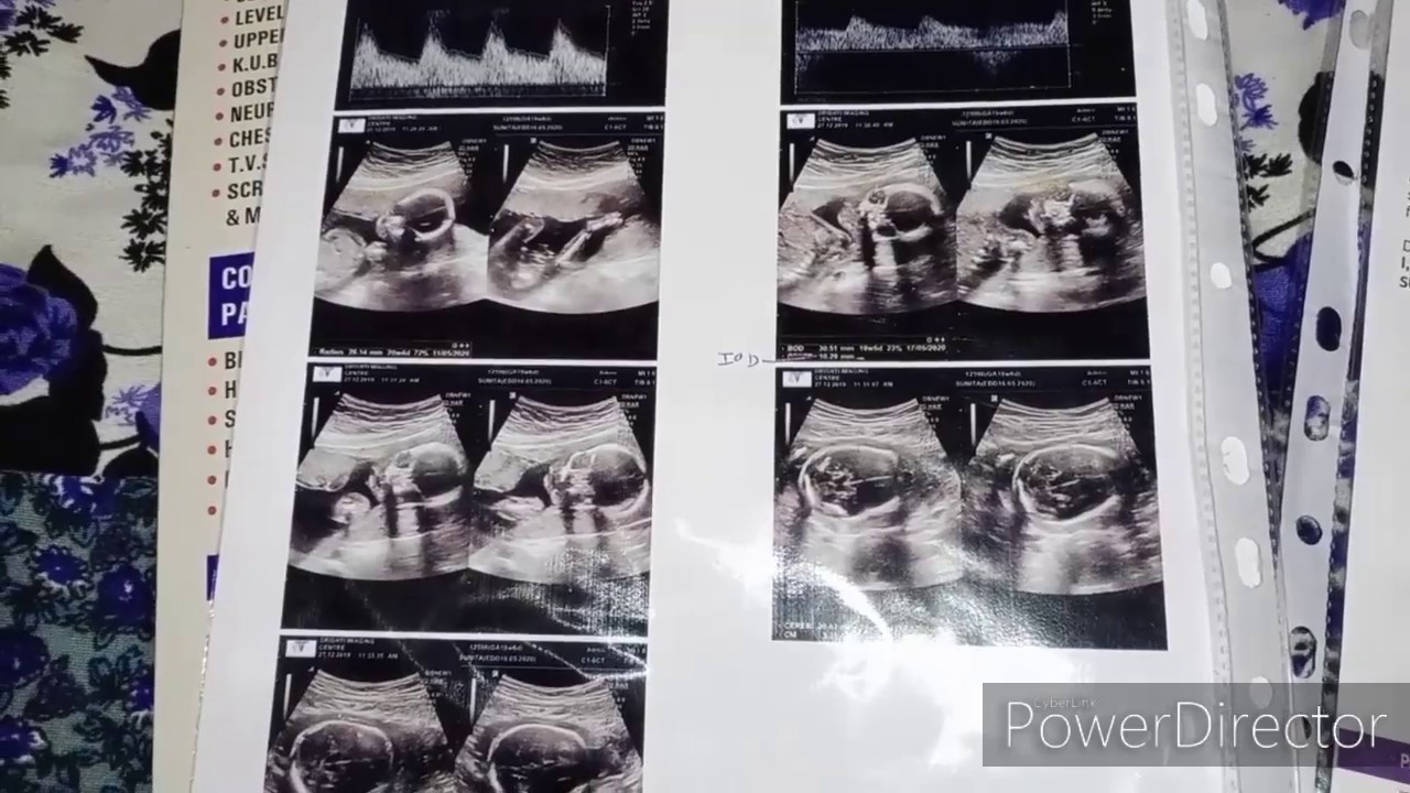 Level 2 Ultrasound ANAMOLY SCAN kab Or Q HOTA H kya Isse Baby Ka level-2-ultrasound-anamoly-scan-kab-or-q-hota-h-kya-isse-baby-ka