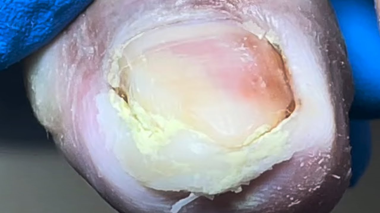 There Is A Circle Of Dead Skin Around The Toenails, How To Deal With It ...