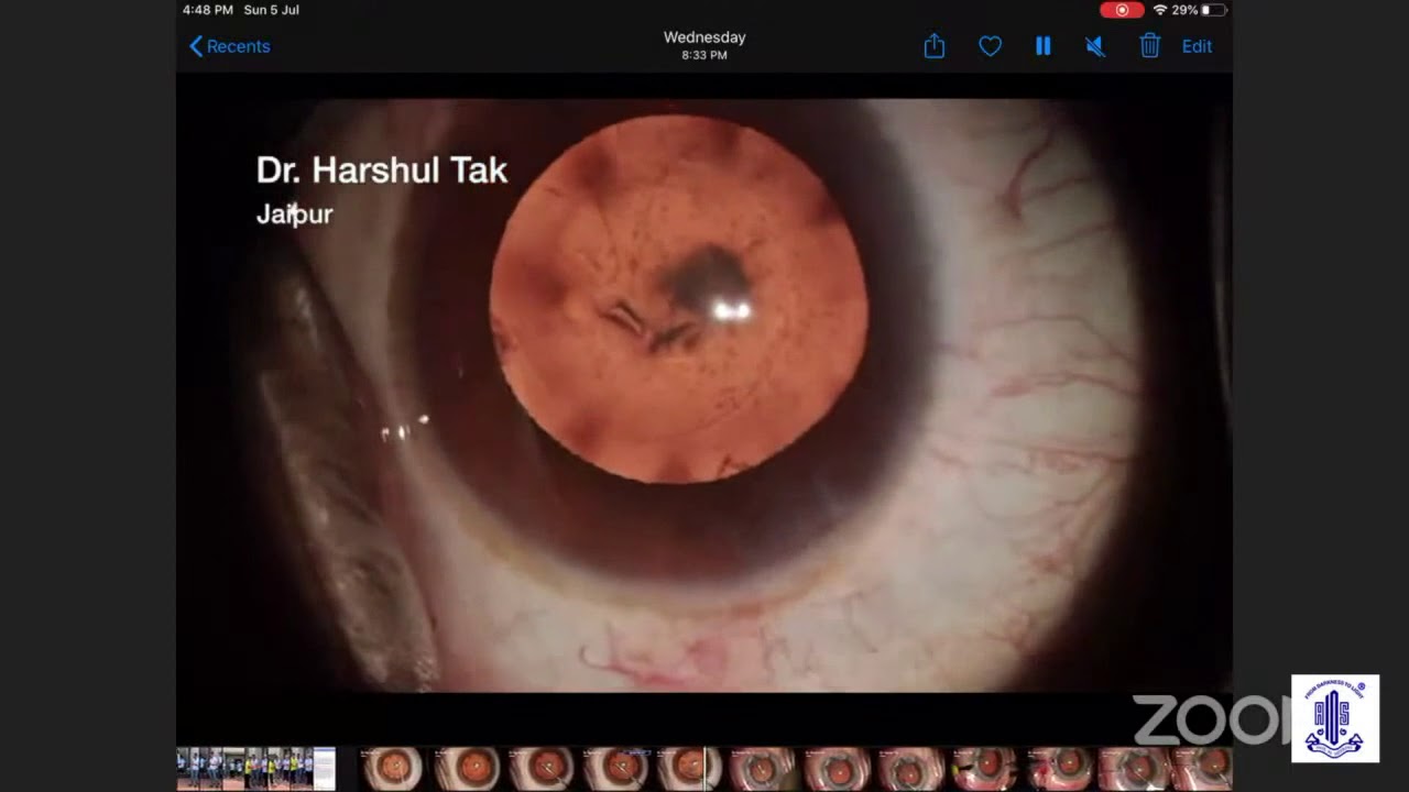 AIOS ARC - Cataract Surgery in Complexities - A Learning-Dr.Harshul tak ...