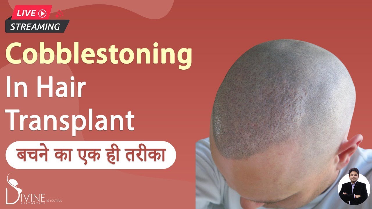 Cobblestoning In Hair Transplant | बचने का एक ही तरीका - YouTube
