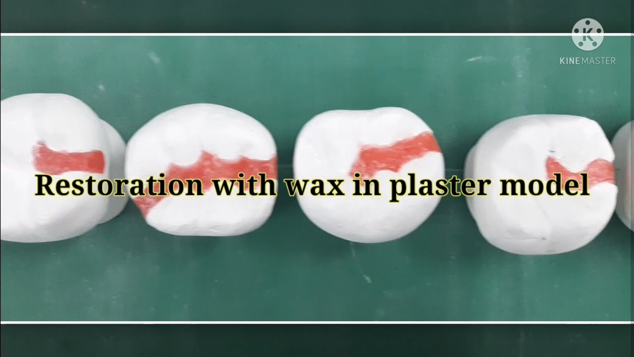 Plaster model : wax restoration in preclinical operative dentistry ...