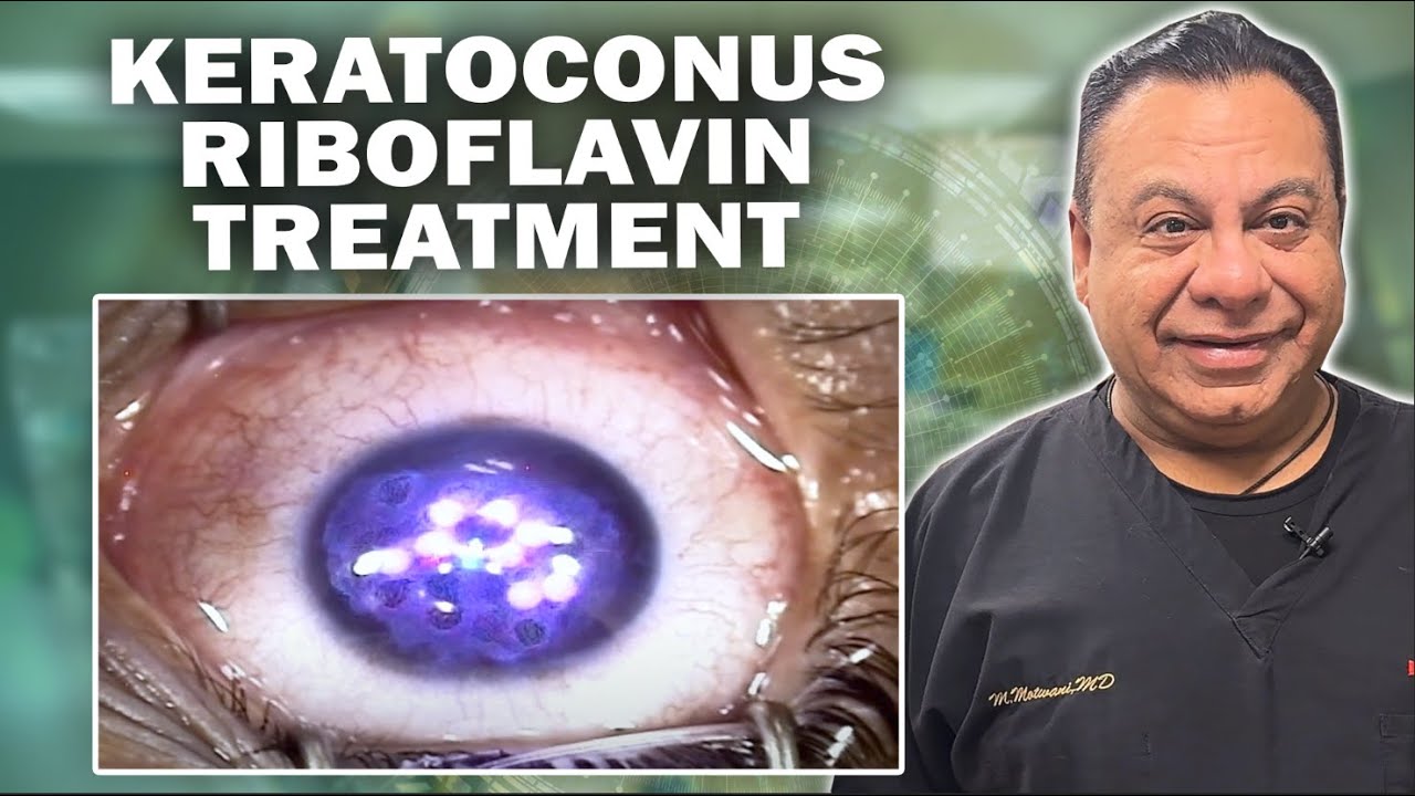 Keratoconus Vision Correction with Riboflavin Treatment - YouTube