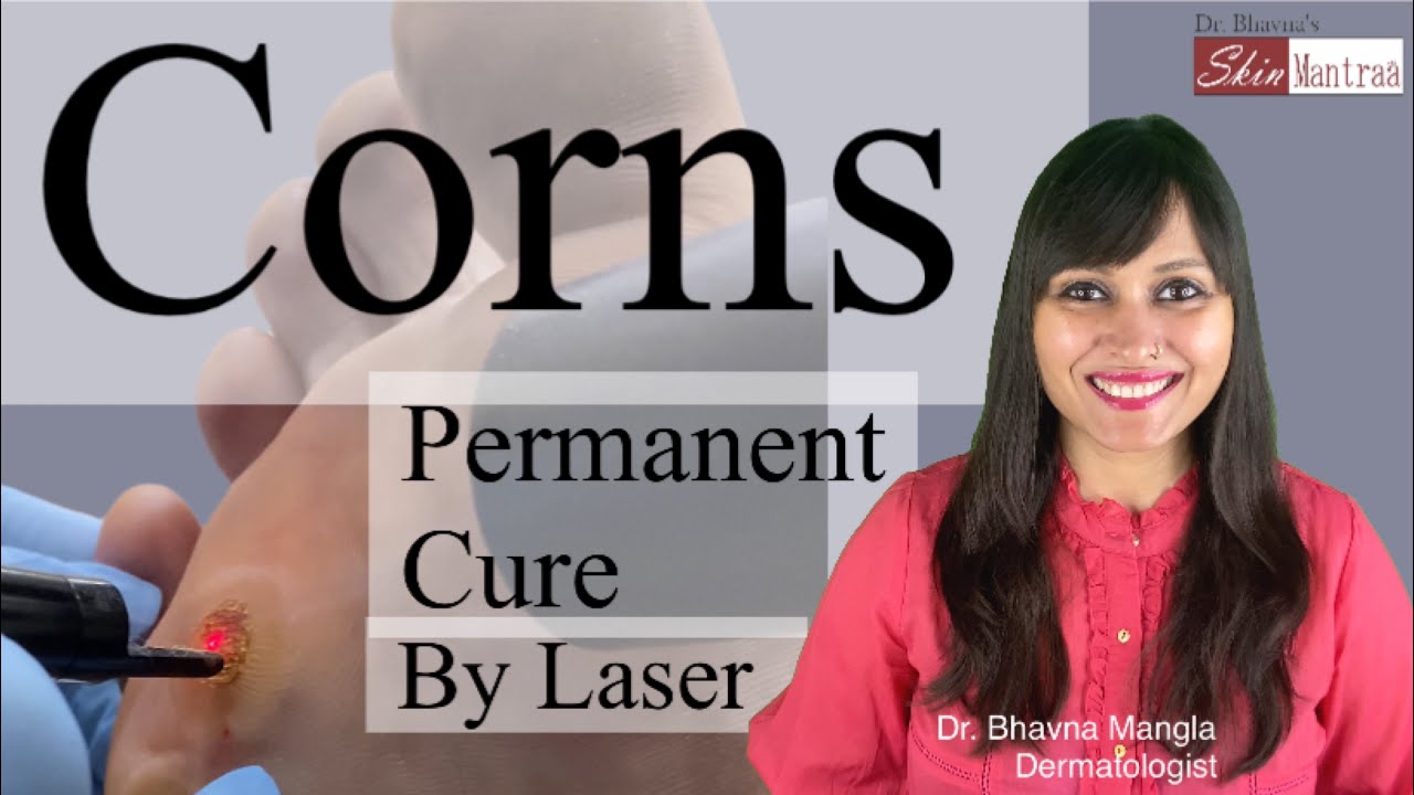 Best treatment for Corn | Permanent cure for Corn | Dr Bhavna Mangla ...