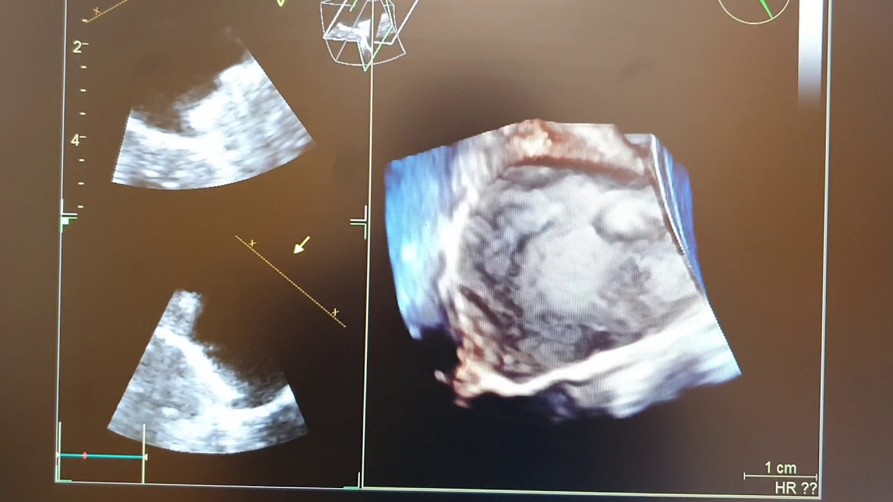 LAA okkluder , TOE - YouTube