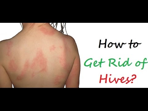 how to get rid of hives | home remedies for hives - YouTube