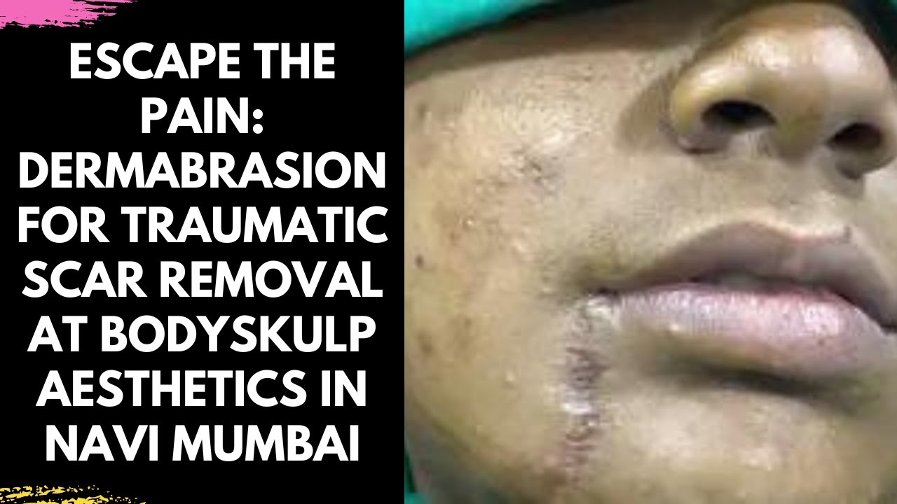Escape the Pain: Dermabrasion for Traumatic Scar Removal at Bodyskulp ...