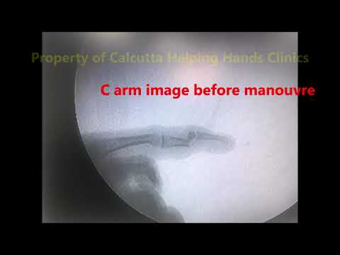Percutaneous osteoclasis for delayed presentation fracture neck of ...