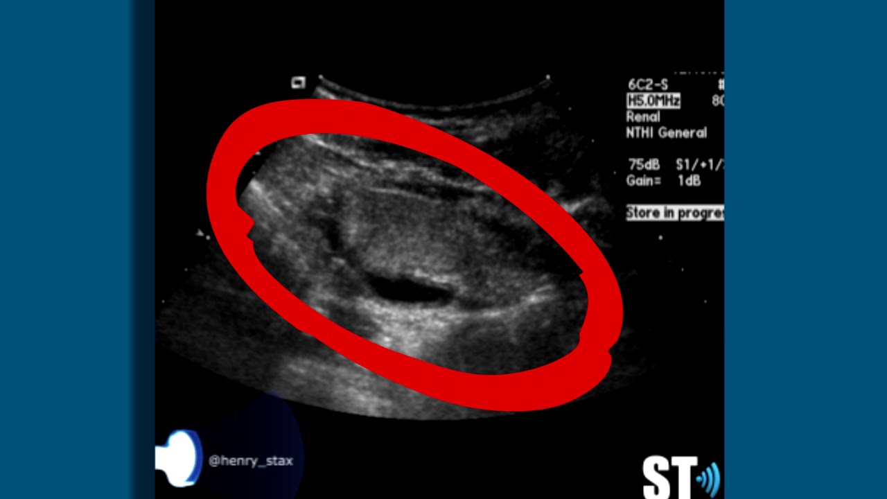 Reflux Nephropathy Ultrasound - YouTube
