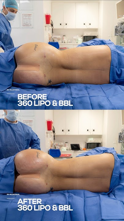 DRAMATIC TRANSFORMATION | 360 Lipo & BBL Before & After Reveal - YouTube
