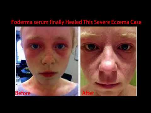 foderma eczema serum before and after - YouTube