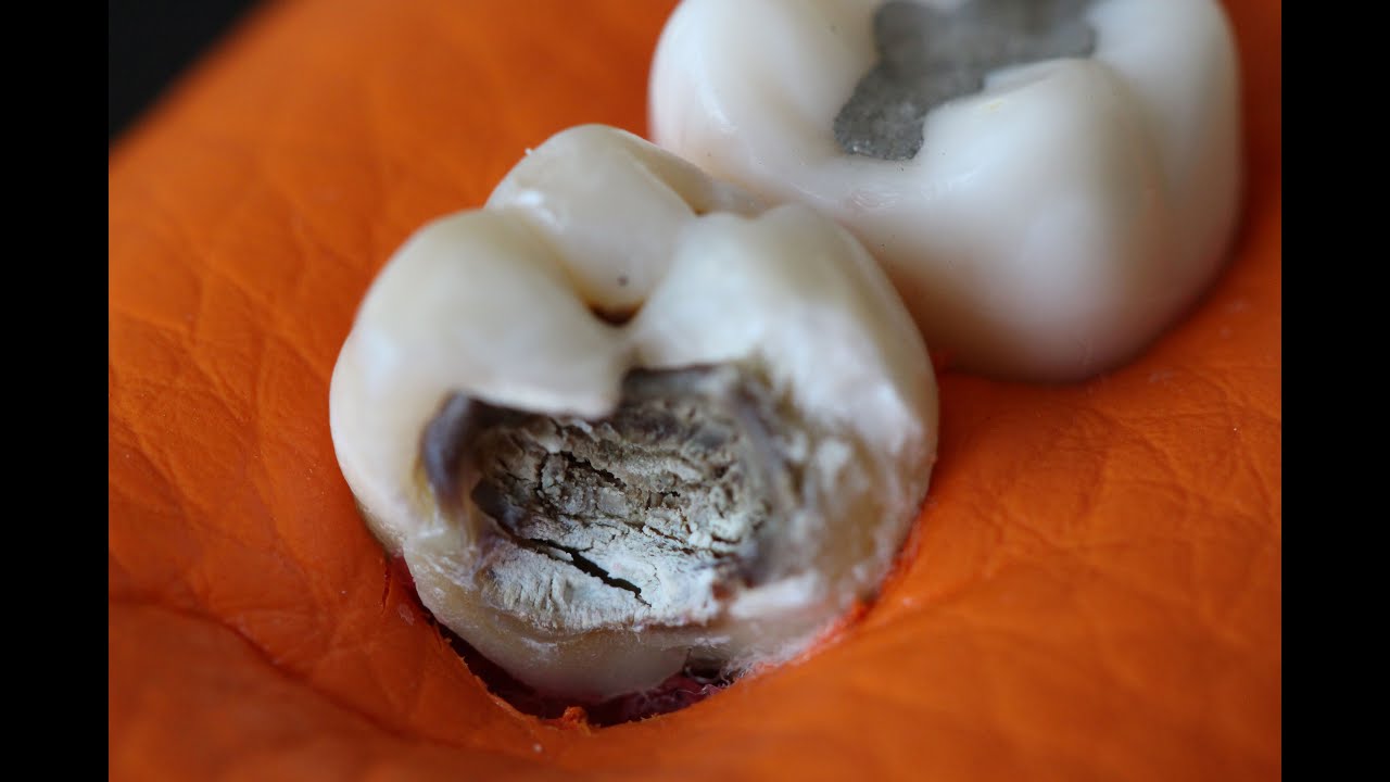 🦷 Miraculous Molar Restoration: Bringing Teeth Back to Life! Root 🌟Root ...