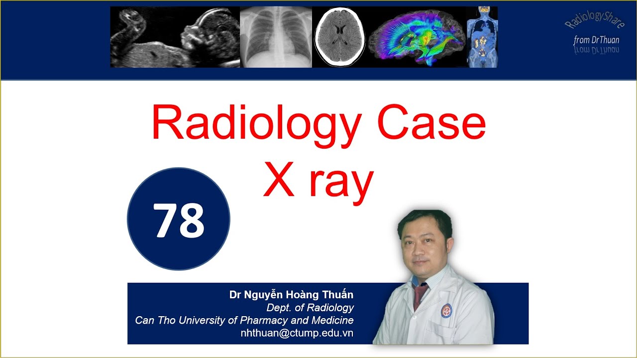 ca 78 anwser - YouTube