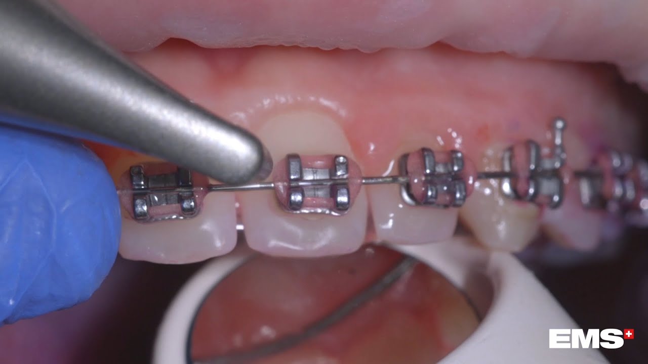 Brackets & GBT - Guided Biofilm Therapy - YouTube