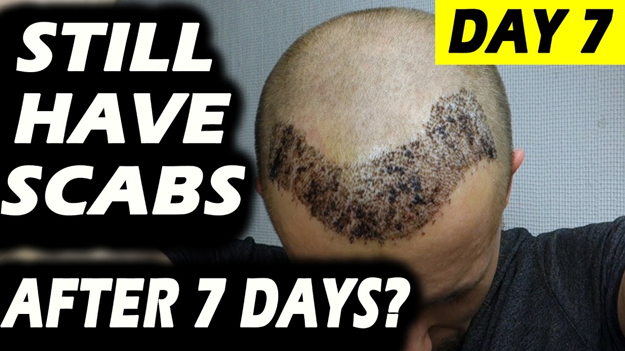 Hair Transplant 7 Days Post Operation Istanbul Turkey Youtube