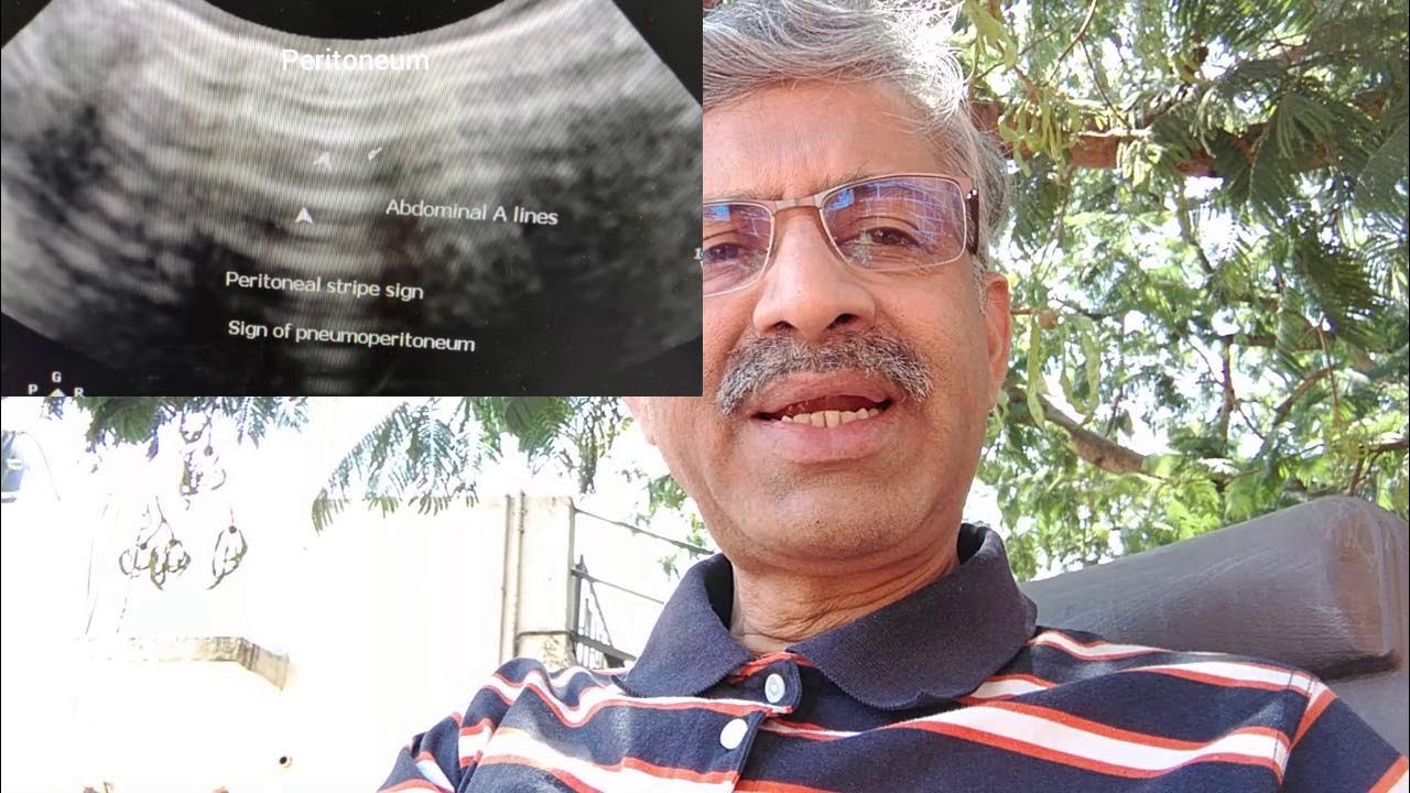Point Of Care Ultrasound In The Diagnosis Of Pneumoperitoneum Youtube