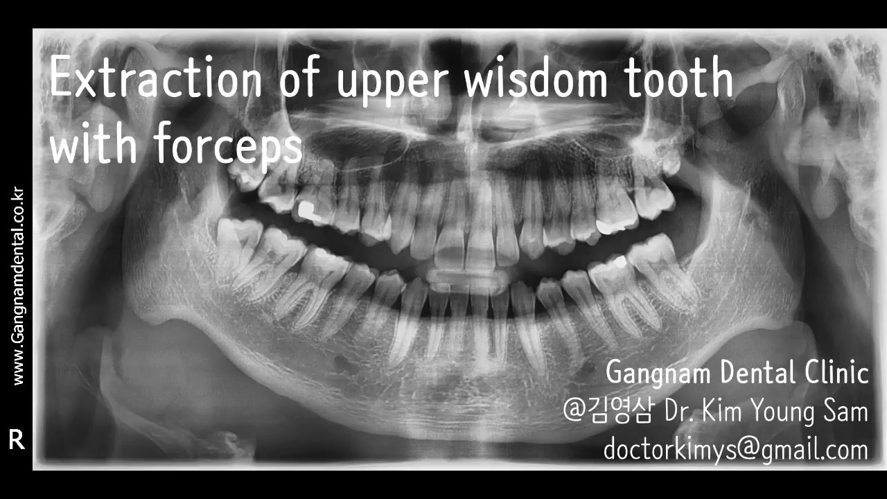 #18 Extraction of upper wisdom tooth with forceps - YouTube