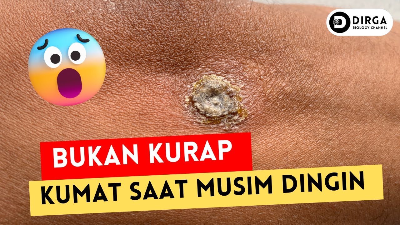 DERMATITIS NUMULARIS/EKSIM NUMMULAR/EKSIM DISKOID-DIRGA BIOLOGY CHANNEL ...