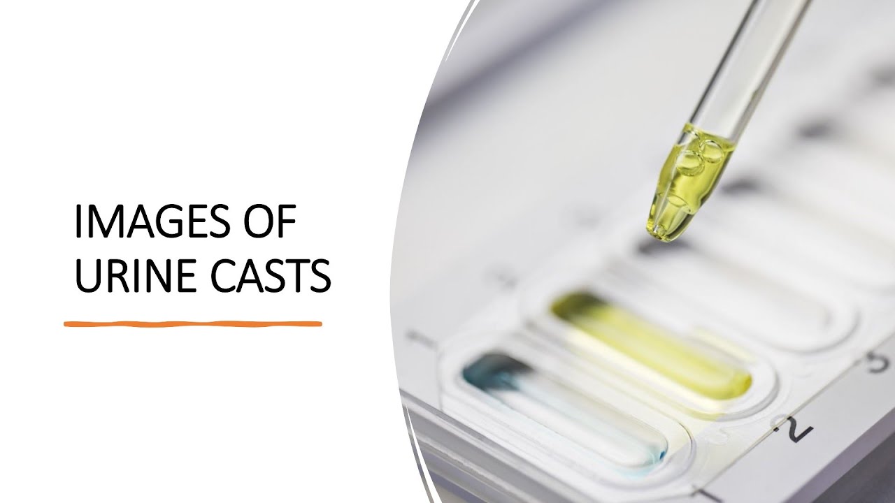 Images Of Urine Casts With Description || RENAL PATHOLOGY - YouTube