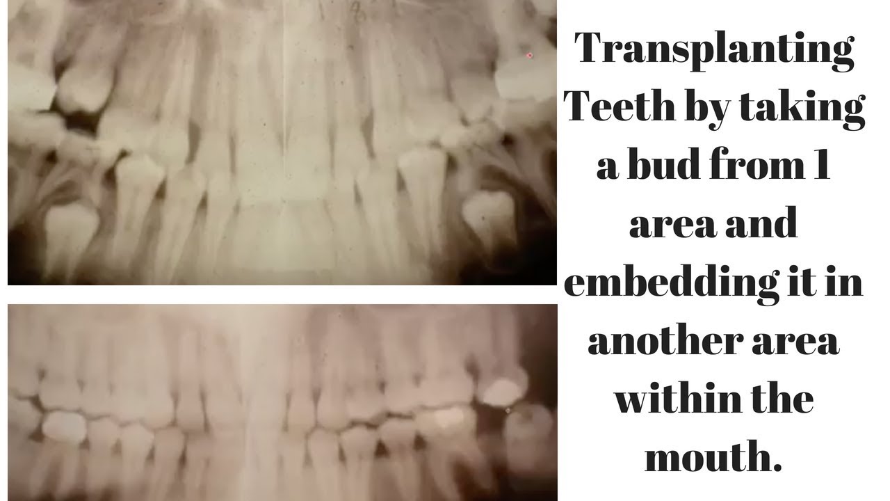 Transplanting Teeth by taking a bud from 1 area and embedding it in ...