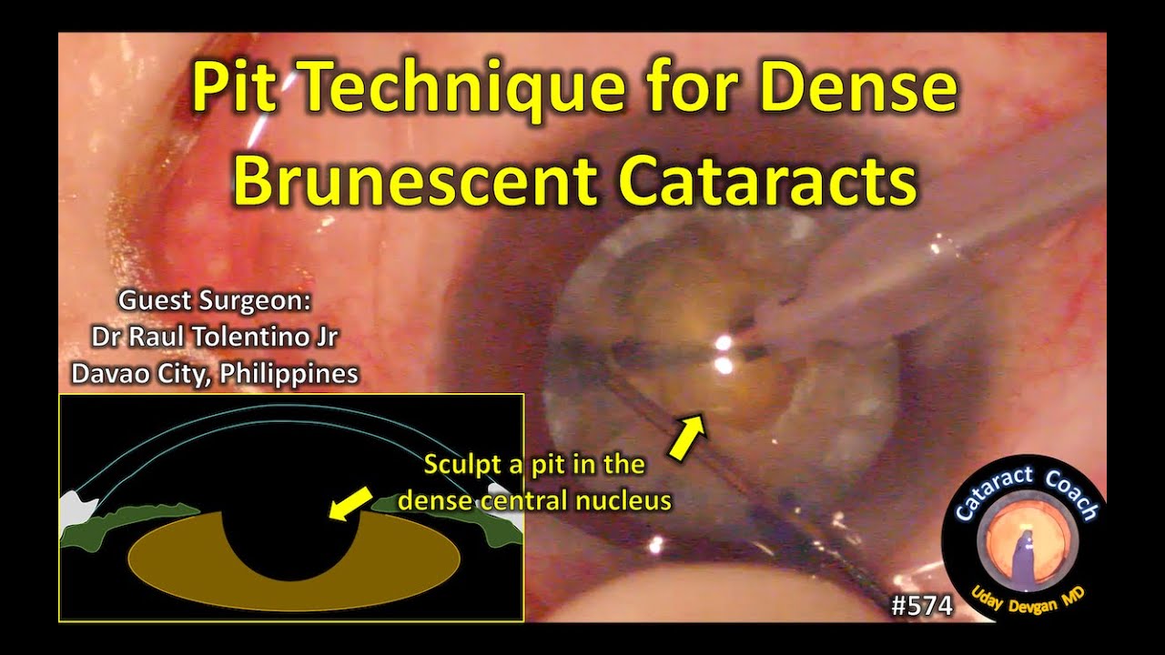 Pit Technique For Dense Brunescent Cataract Surgery Success Youtube