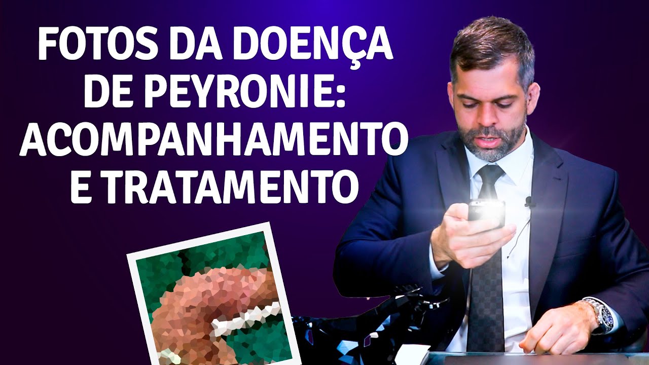 Fotos da Doença de Peyronie acompanhamento e tratamento | Dr. Marco ...
