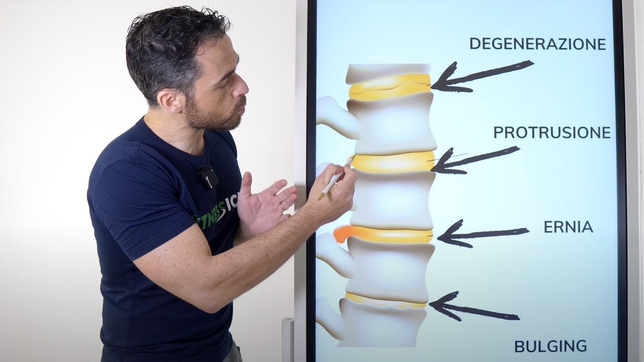 Discopatia C5-C6 o C6-C7: cos'è e cosa fare - YouTube