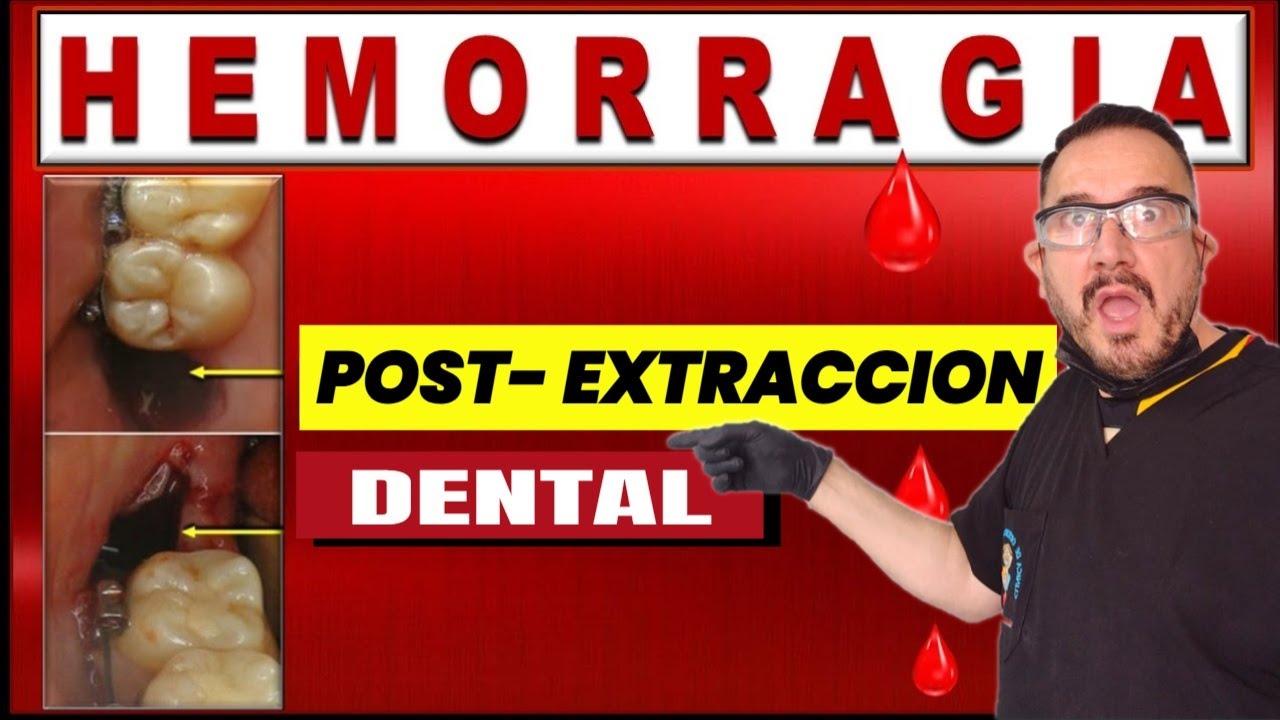 ¿Qué hacer si tienes HEMORRAGIA después de ir al Dentista? - YouTube