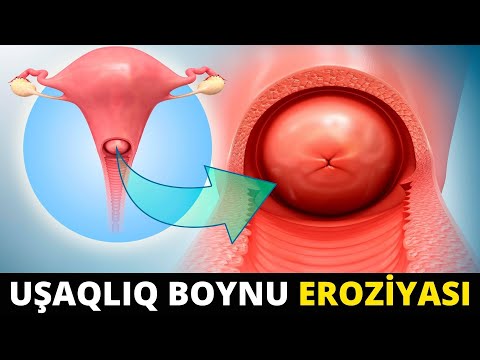 Uşaqlıq Boynu Eroziyası TƏHLÜKƏLİDİR? - Xərçəngə Çevrilə Bilər!