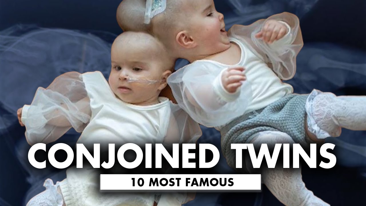 10 World’s Most Famous Conjoined Twins - YouTube