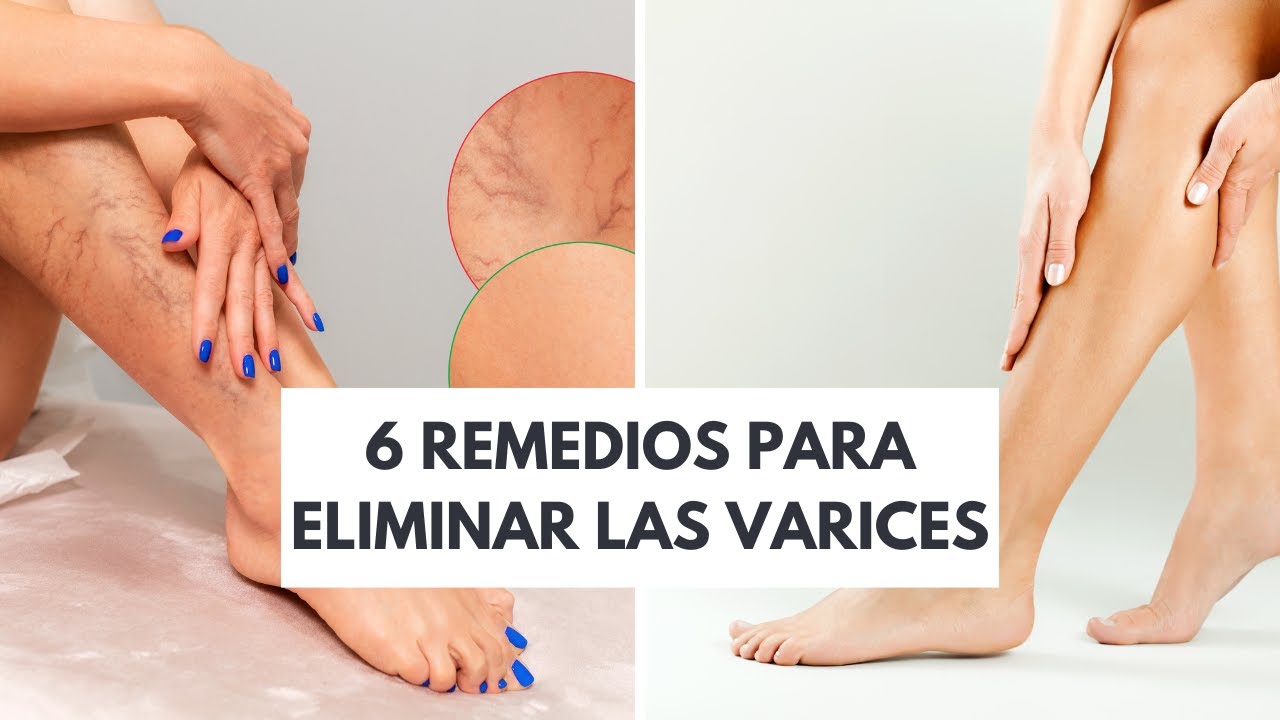 6 Remedios Naturales para Eliminar las Varices en Casa - YouTube