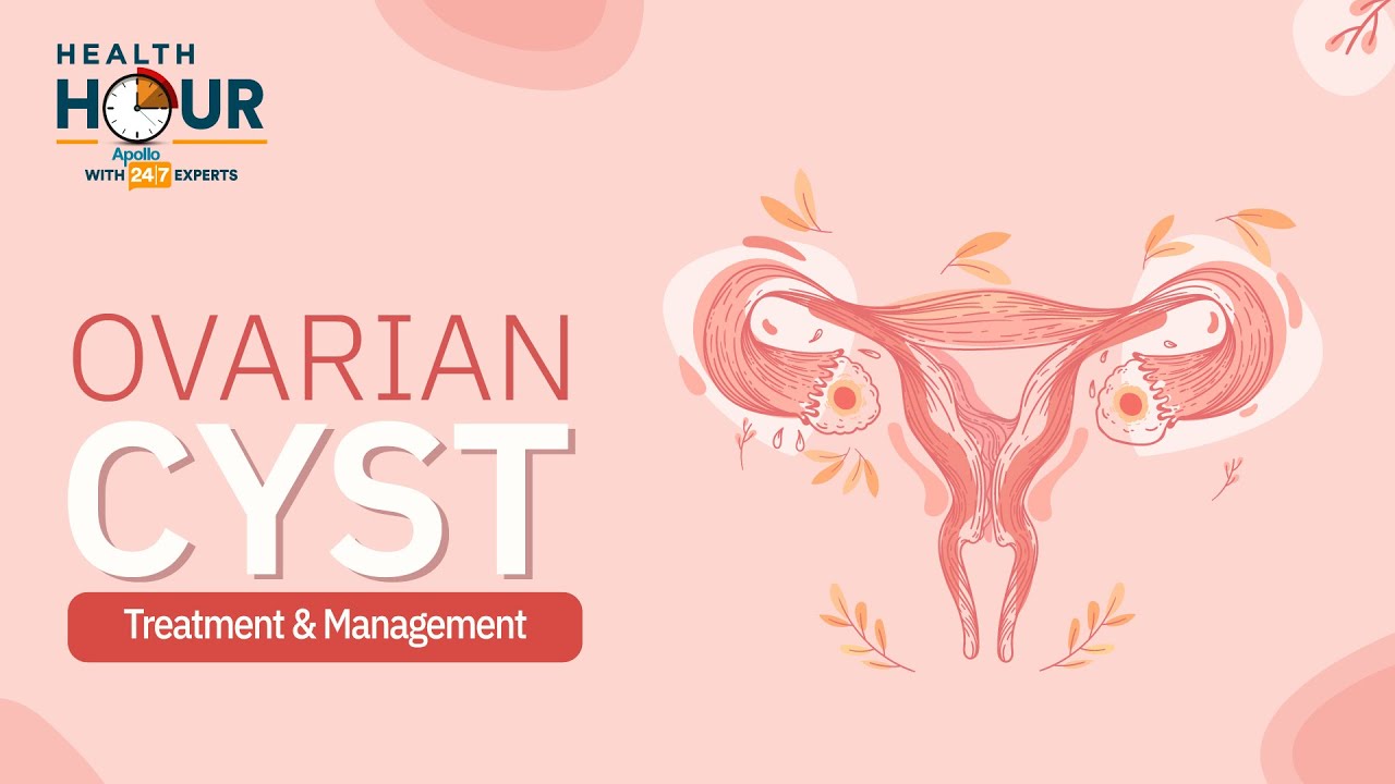 Ovarian Cyst: Treatment and Management | Apollo 24|7 Health Hour | Dr ...