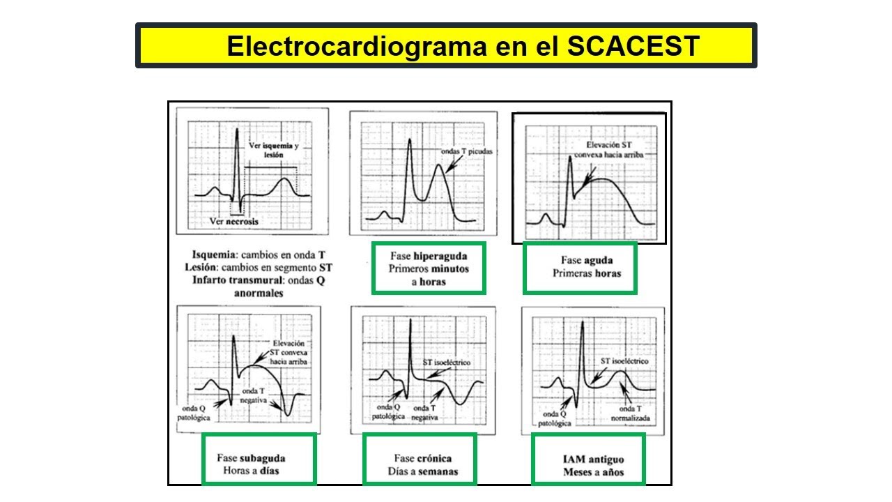 Que debo saber de ECG en SCA para hacer una guardia - YouTube