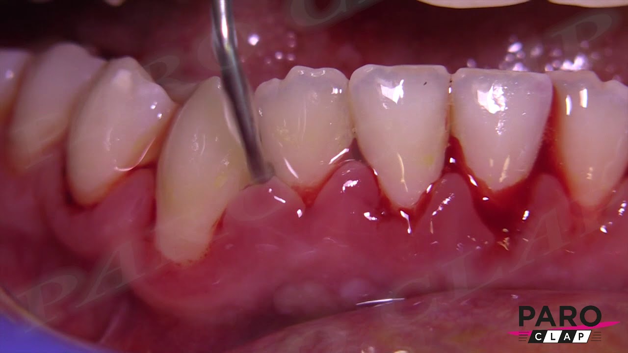 Traitement gingivite - YouTube