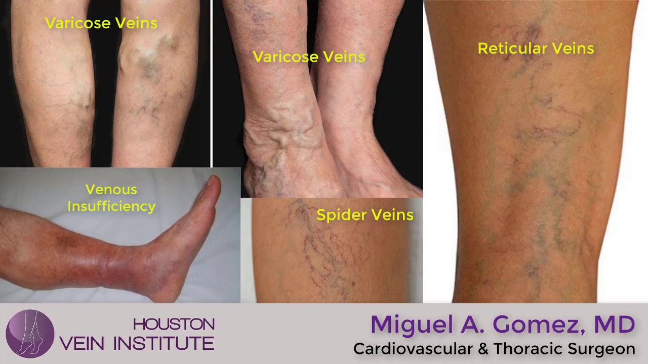 Houston Vein Institute - Dr Miguel A. Gomez - YouTube