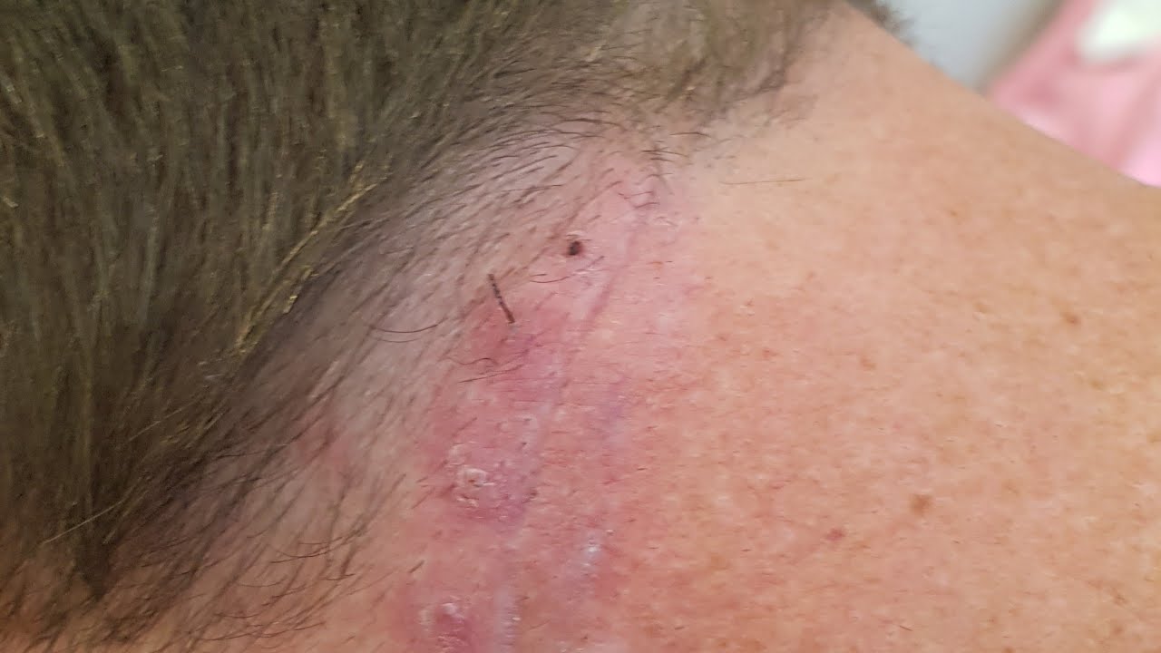 Overgrown Suture Removal On Neck - YouTube