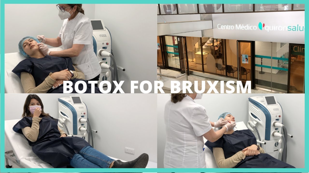 🩸💉botox For Bruxism Before And After Alexbeauty💉🩸 Youtube