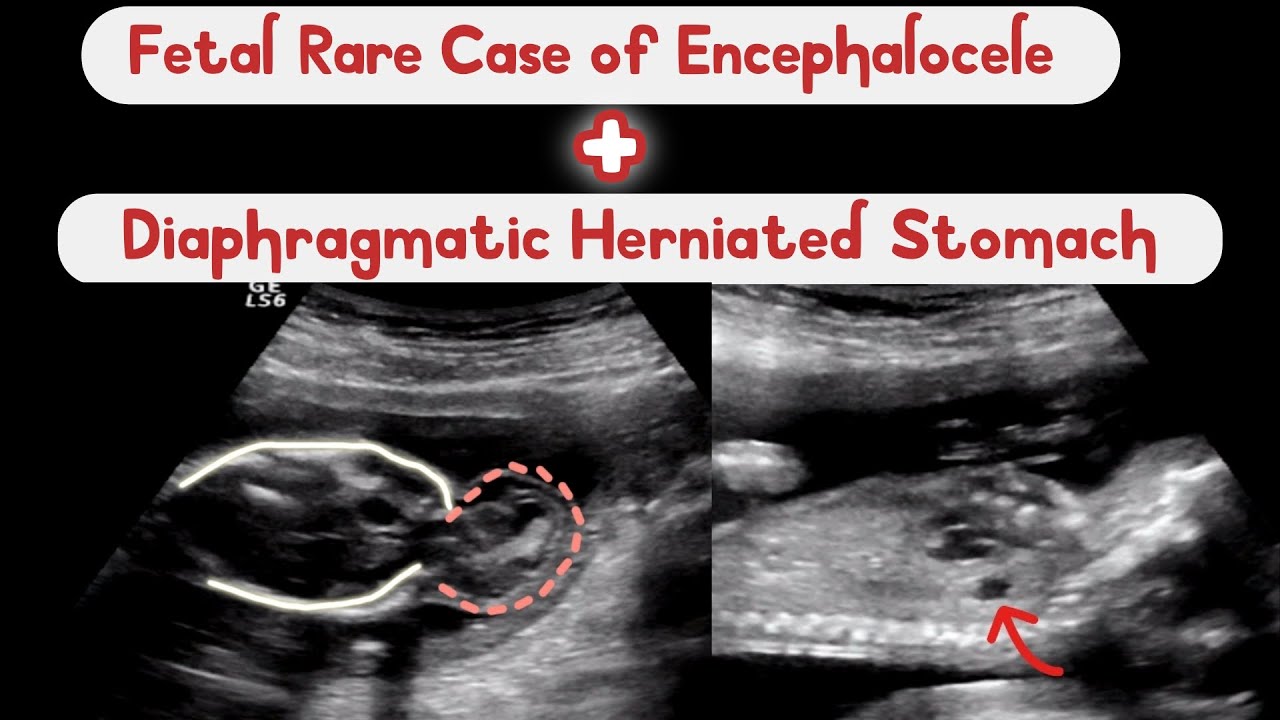 Rare Ultrasound Case of Fetal Encephalocele and Congenital ...